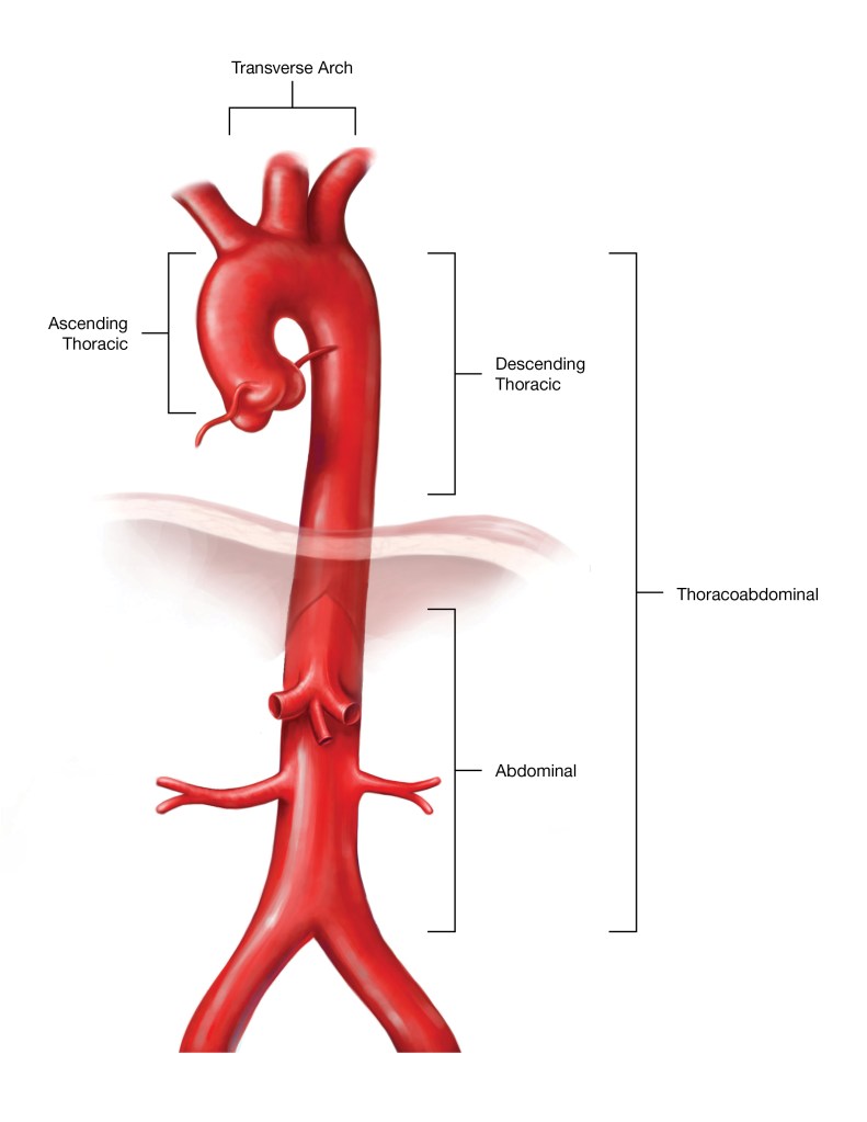 Aortic Aneurysm UAB Medicine Aortic Aneurysm UAB Medicine