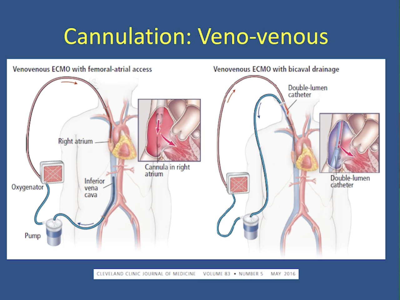 Extracorporeal Life Support in Advanced Lung Disease