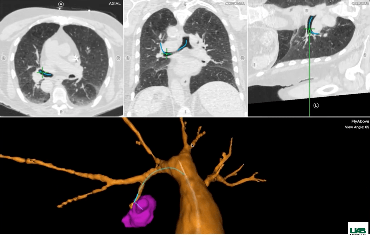 Interventional Pulmonology - UAB Medicine