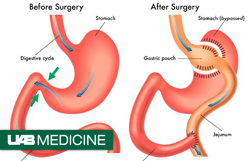 Bariatric Surgery